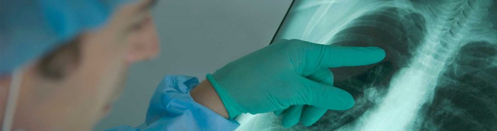 Bronchiolitis Obliterans (Popcorn Lung Disease) | Diacetyl Exposure