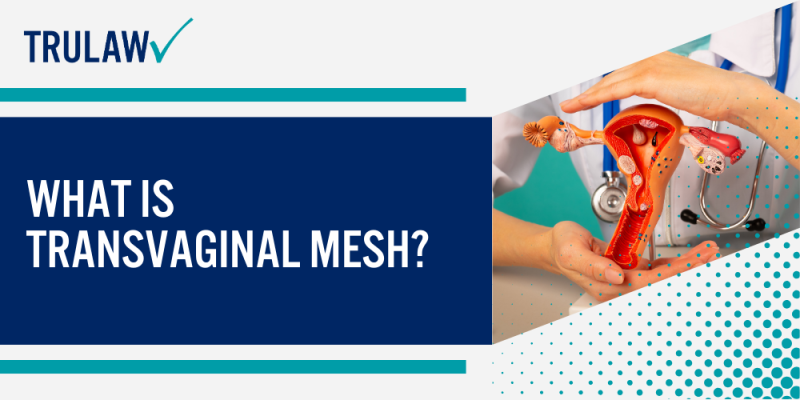 FAQ: What Is Trans Vaginal Mesh Used For? | TruLaw